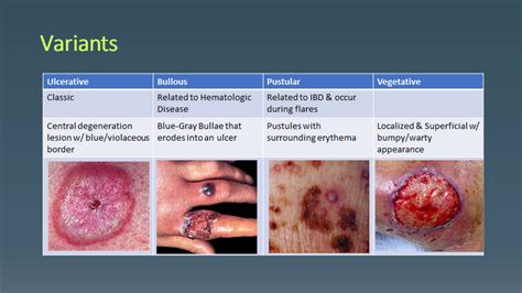 Pyoderma Gangrenosum Scvmc Im Chief Resident Blog