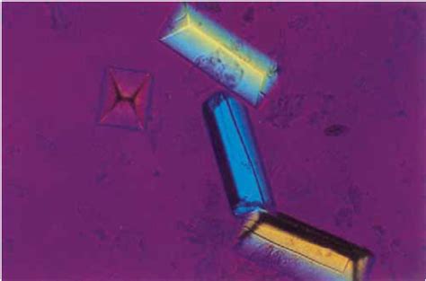 Variation In Triple Phosphate Crystals Medical Laboratories