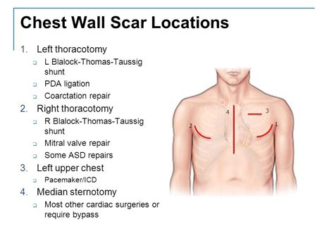 Chest Wall Scars Rmedpedia