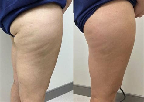 Tratamento para Celulite nas Coxas Subcisão e Ácido Polilático