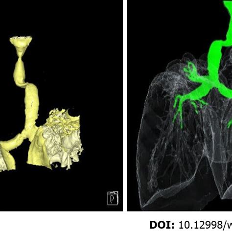 3d Computed Tomography Reconstruction Of The Trachea Download