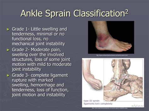 Ankle Sprain Grade 3 At Flynn Rowan Blog
