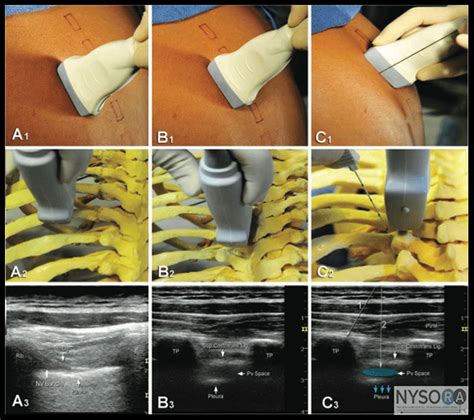 Thoracic Paravertebral Block Nysora The New York School Of Regional
