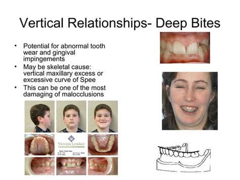 Phase I Orthodontic Treatment Ppt Dental Health Diseases And