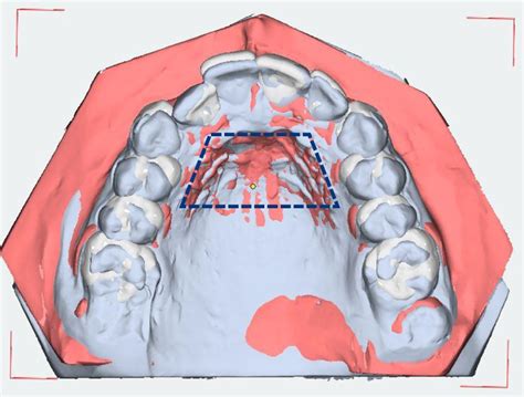 Superimposition Of Maxillar Models Initial And Intermediate Models Download Scientific