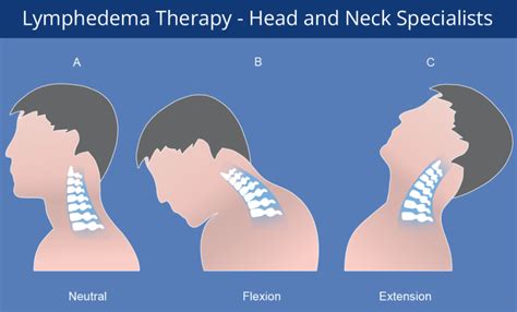 Lymphedema Therapy Head And Neck Specialists The Norton School Blog