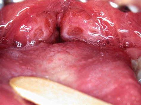 Hypertrophic Palatine Tonsils Source Authors File Download