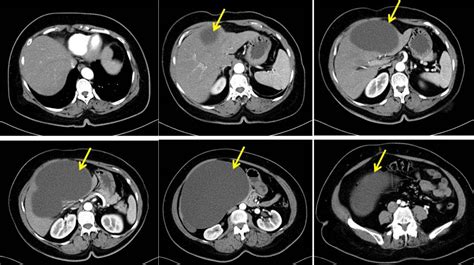 Mucinous Cystic Neoplasm Of The Liver Radiology Cases