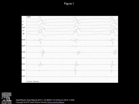 An Unusual Approach To Intractable AVNRT In A Pediatric Patient Ppt