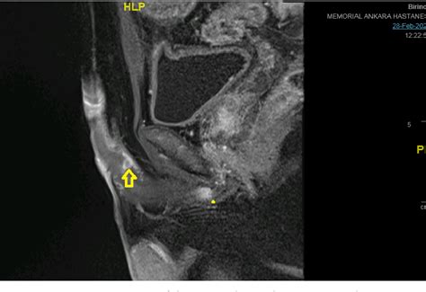 Figure 2 From A Rare Case Of Penile Metastasis Secondary To Pancreatic