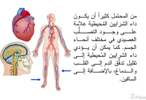 داء الشرايين المحيطية