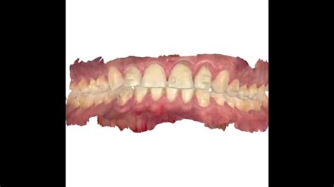 Take On Task Of Planning Your Clear Aligner Orthodontic Case By