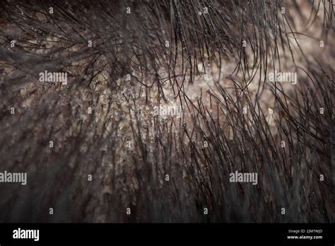 Macro Shot Of Dandruff On Scalp Of A Man Hair Fall Problem Itchy