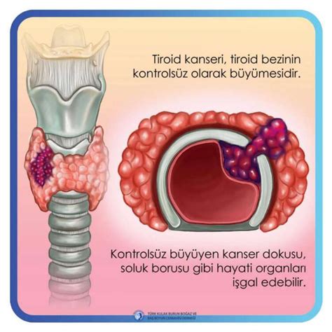 Thyroid Surgery Erkan Karataş Prof Dr
