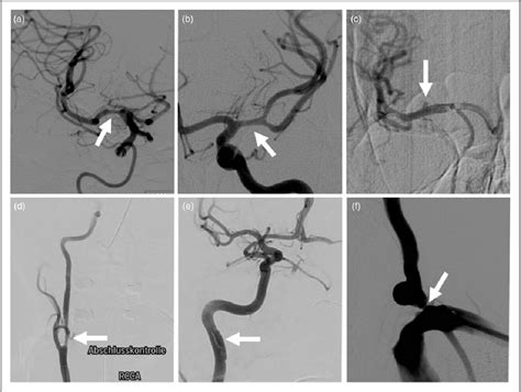 Figure 1 From Etiology Of Recurrent Large Vessel Occlusions Treated With Repeated Thrombectomy