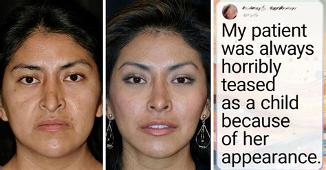 15 Daring People Who Got Plastic Surgery And Transformed Themselves