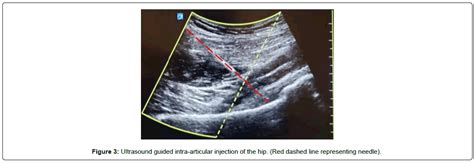 The Effectiveness Of Bone Marrow Aspirate Injection For Osteoarthritis