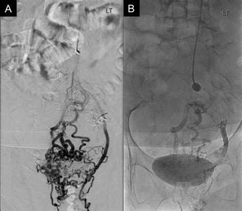 A Dilated Rectal Varices In A 59 Year Old Female With Intractable Download Scientific Diagram