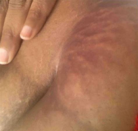 Infected Endometrioma Of The Abdominal Wall A Rare Cause Of Cellulitis