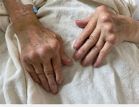 Ulnar Deviation Of Metacarpophalangeal Joints With Swanneck Deformity Download Scientific