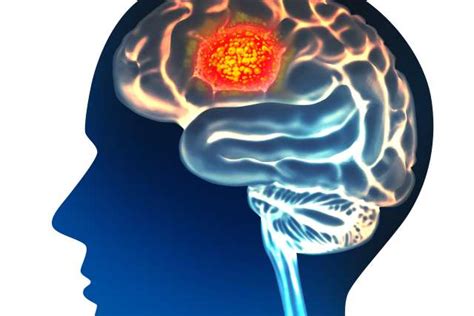 Ucla Researchers Identify A Gene As A Potential Target In Treatment
