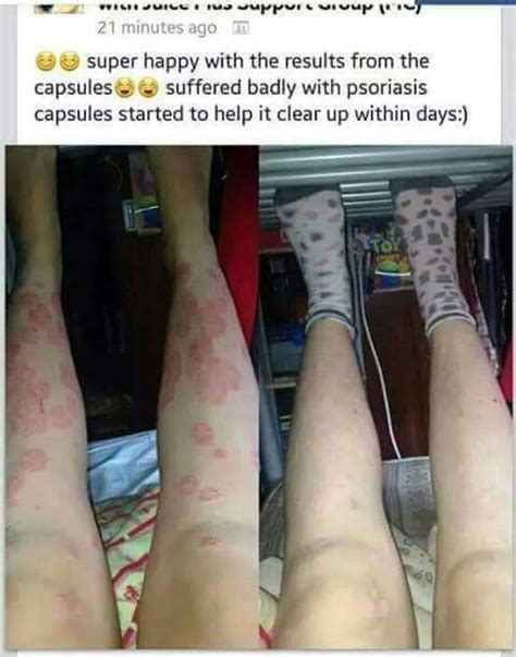 Psorasis Who Wants Something To Help Theres Clear Up Juice