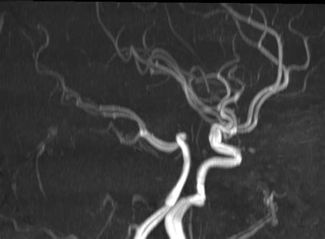 뇌 Ct Mri Mra 뇌질환 검사 차이 비용 네이버 포스트