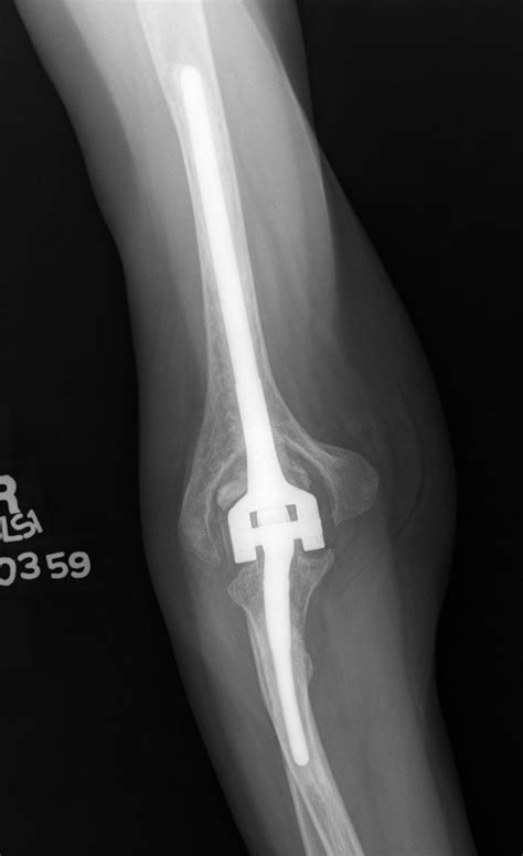 Rheumatoid Elbow Cancer Therapy Advisor