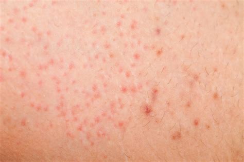 What Do Red Dots On Skin Mean 13 Skin Spots And Bumps Pictures