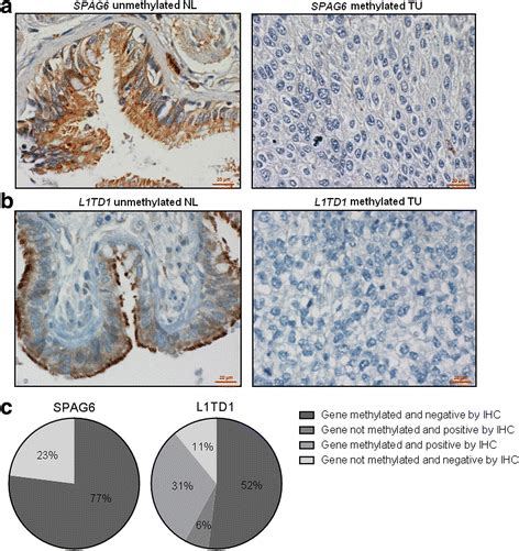 Protein Expression Of Spag6 And L1td1 In Nsclc Patients Representative Download Scientific