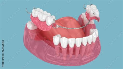 Removable Partial Denture Mandibular Prosthesis Medically Accurate 3d Animation Of