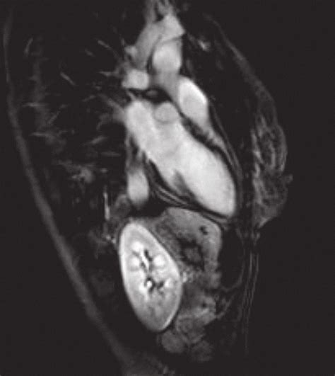 Mri Global Left Ventricular Hypokinesis With Depressed Ejection