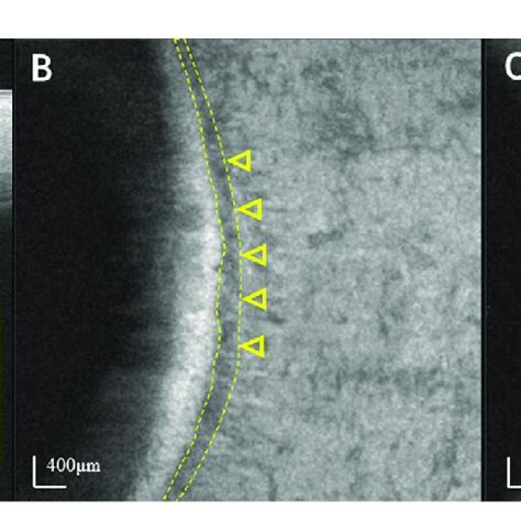 Identification Of Sc Using Swept Source Optical Coherence Tomography Download Scientific