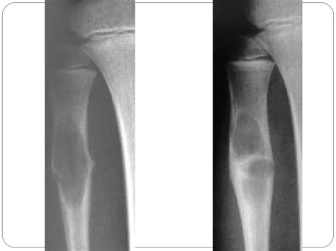 Unicameral Bone Cysts Ppt