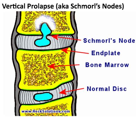 Thoracic Spine Flashcards Quizlet