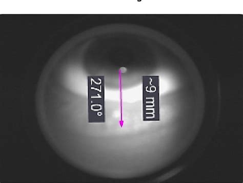 Figure 1 From Validation Of A Semiautomatic Optical Coherence Tomography Digital Image
