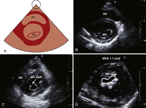 Echocardiography Radiology Key