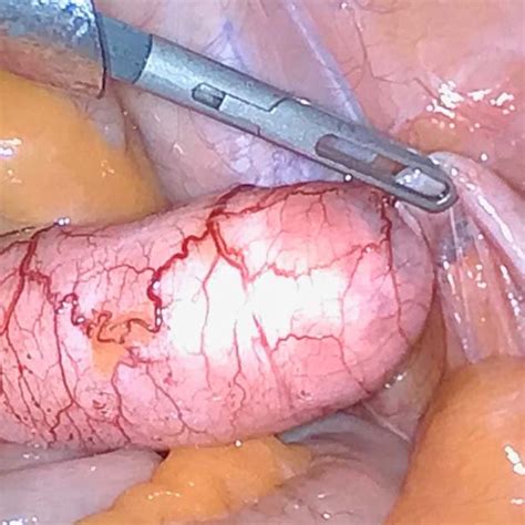 Inverted Appendix Normal Variant Download Scientific Diagram