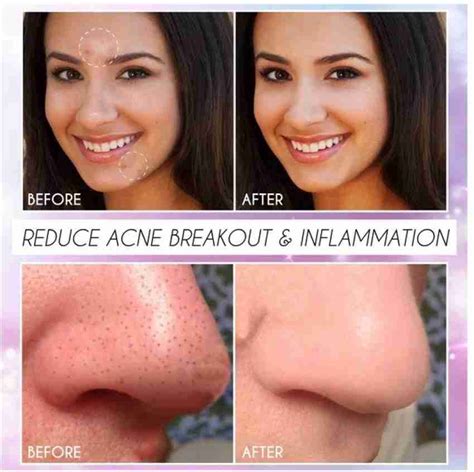 Salicylic Acid Before And After
