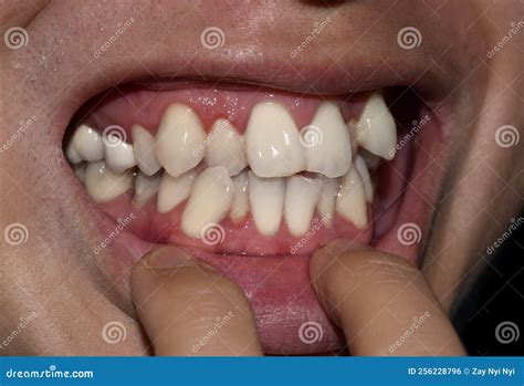 Stacked Or Overlapping White Teeth Also Called Crowded Teeth Stock