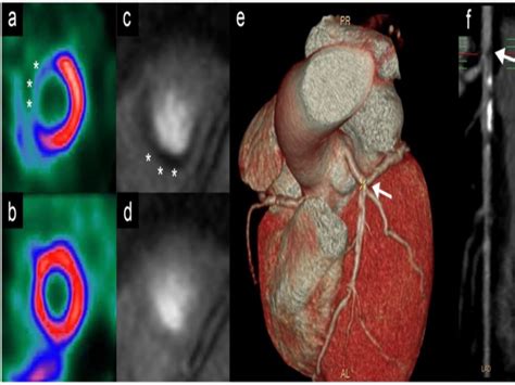 Non Invasive Coronary Imaging Market Is Booming Worldwide With Cagr Of