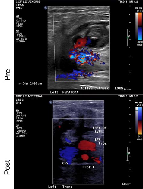 Complex Femoral Pseudoaneurysm With Arteriovenous Fistula And Large