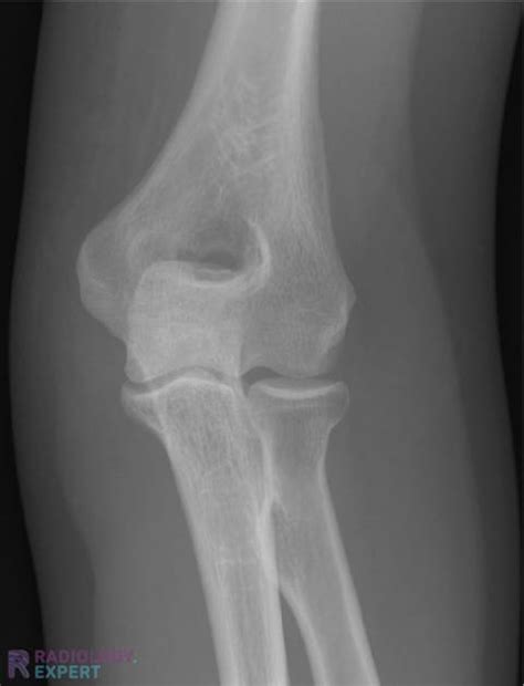X Ray Elbow Normal