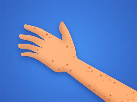 Η ευλογιά των πιθήκων μεταδίδεται μόνο με σεξ Οι πέντε μεγάλοι μύθοι γύρω από την ασθένεια