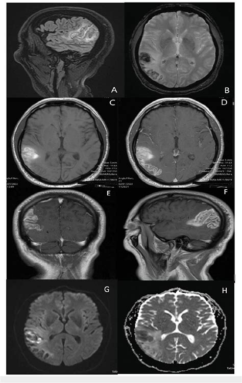 Figure 1 From Subpial Hemorrhage In An Adult Male Semantic Scholar