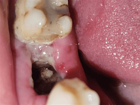 Does This Look Like A Dry Socket Raskdentists