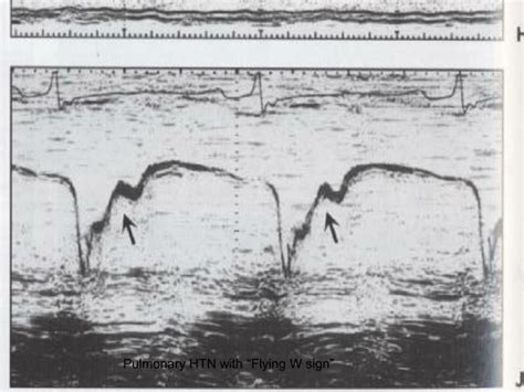 Ppt M Mode Echocardiography Powerpoint Presentation Id 6591486