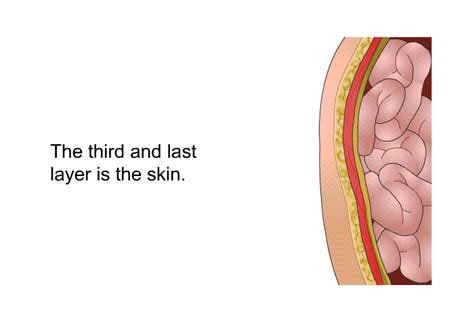 Epigastric Hernia Repair Laparoscopic