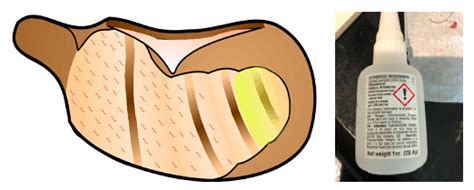 Perilymph Sampling From The Cochlear Apex