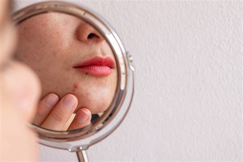 Adult Acne Causes And Treatment Options Pennsylvania Dermatology